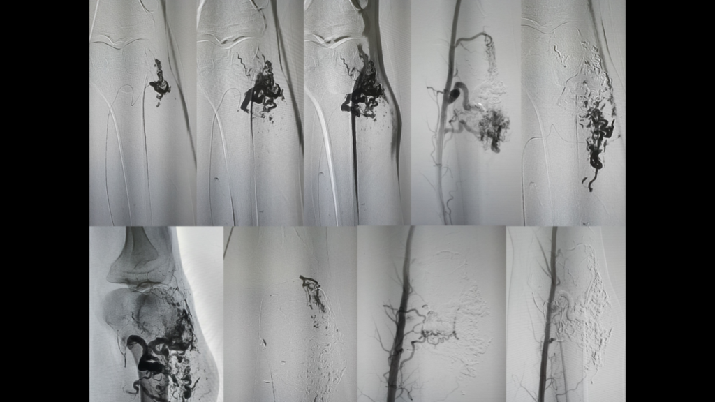 Peripheral AVMs pre-operative embolization using plug and push ...